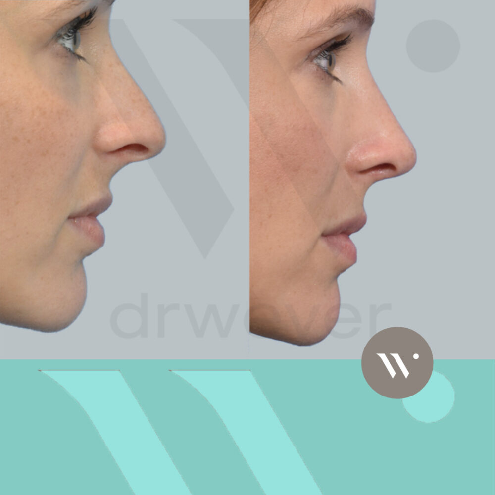 Neuscorrectie resultaten voor en na - Dr. Wever - Internationaal ...