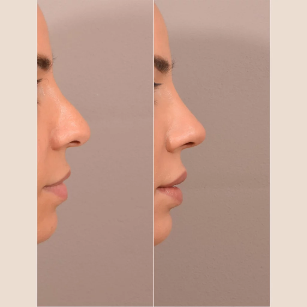 Neuscorrectie resultaten voor en na | Specialist Dr. Wever..